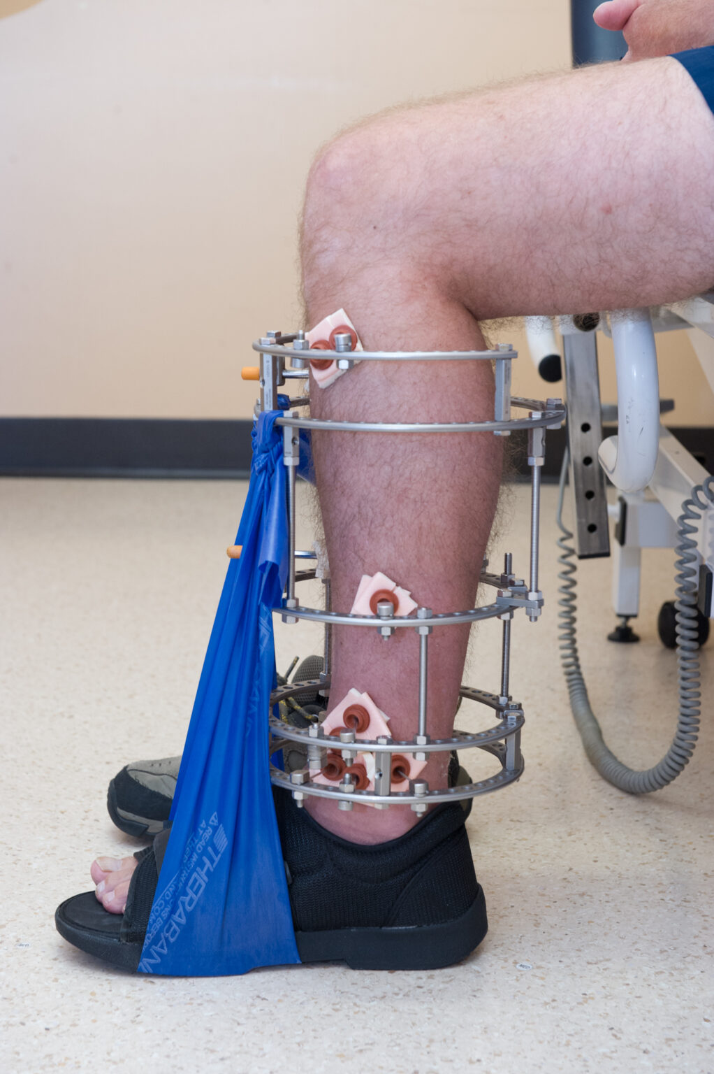 Having an External Fixation Device - Adults - Leeds Teaching Hospitals ...