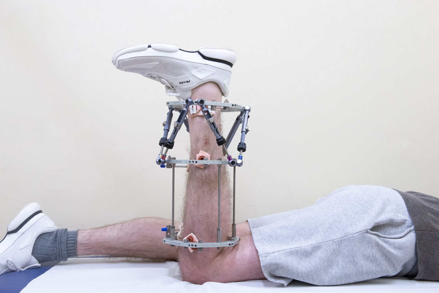 Having an External Fixation Device - Adults - Leeds Teaching Hospitals ...