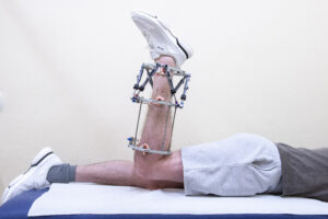 Having an External Fixation Device - Adults - Leeds Teaching Hospitals ...