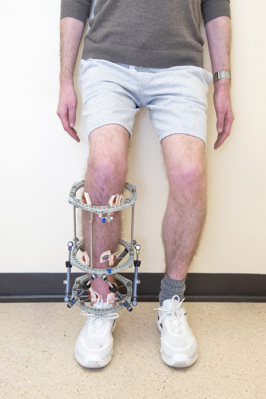 Having an External Fixation Device - Adults - Leeds Teaching Hospitals ...