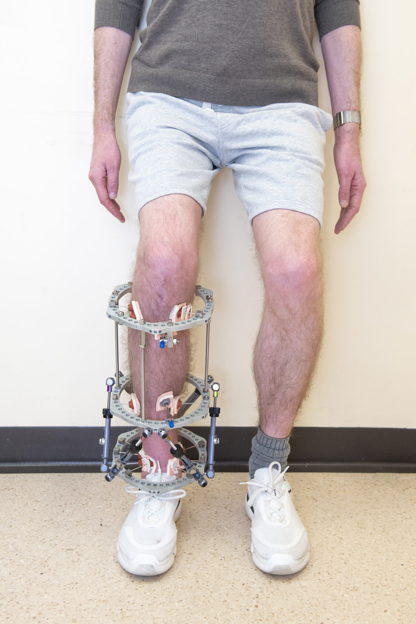 Having an External Fixation Device - Adults - Leeds Teaching Hospitals ...