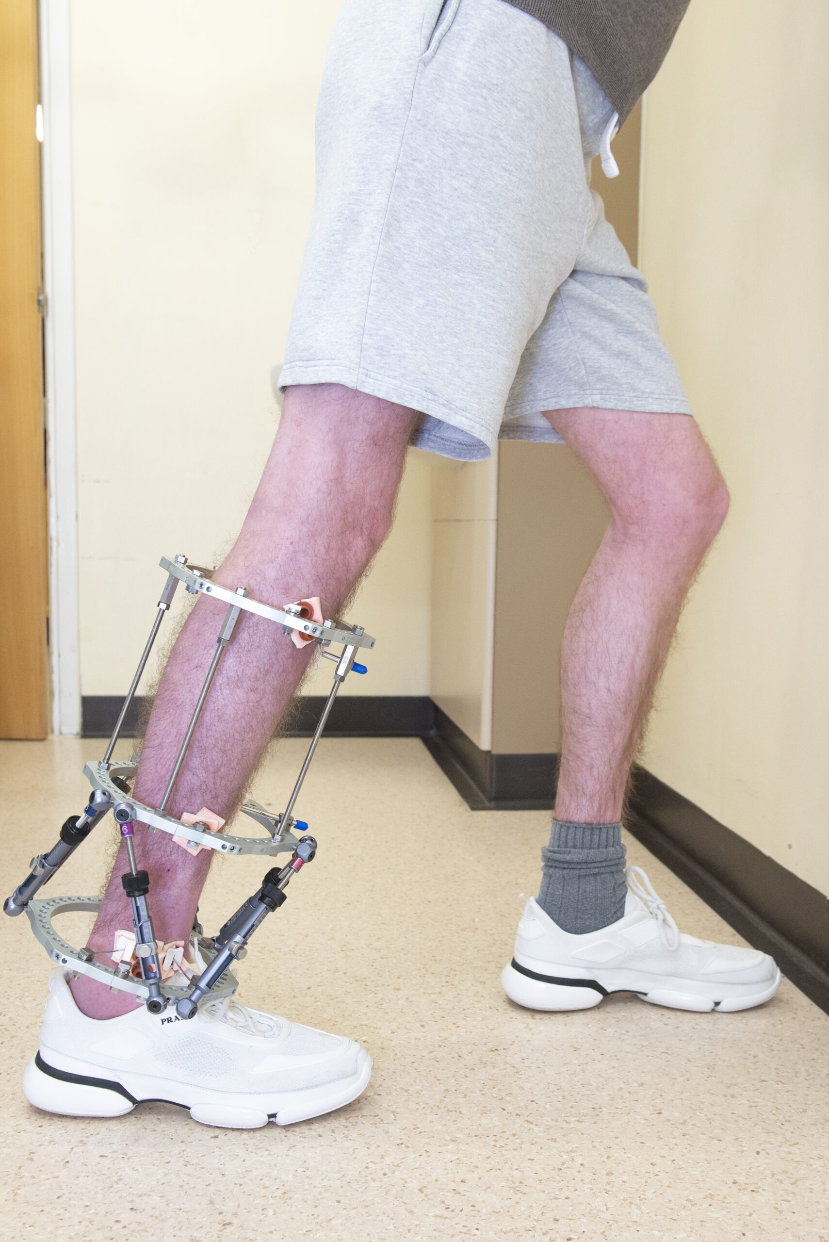 Having an External Fixation Device - Adults - Leeds Teaching Hospitals ...