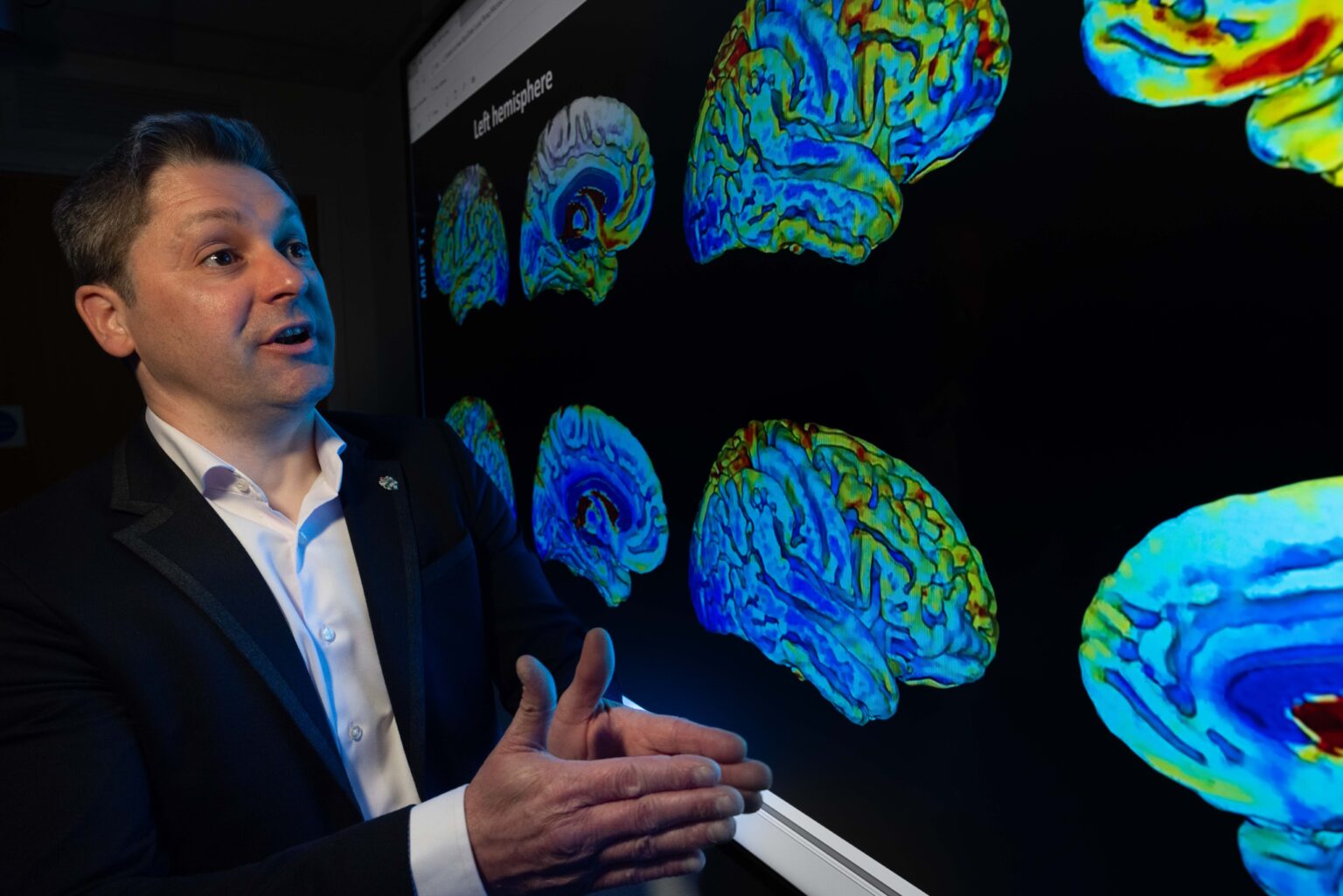 Ambitious UK-first Motor Neurone Disease research projects are launched ...