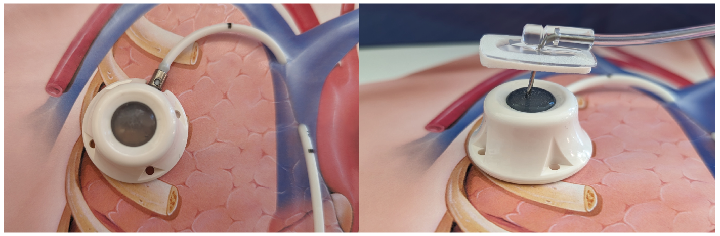 Totally Implantable Venous Access Device - Leeds Teaching Hospitals NHS ...