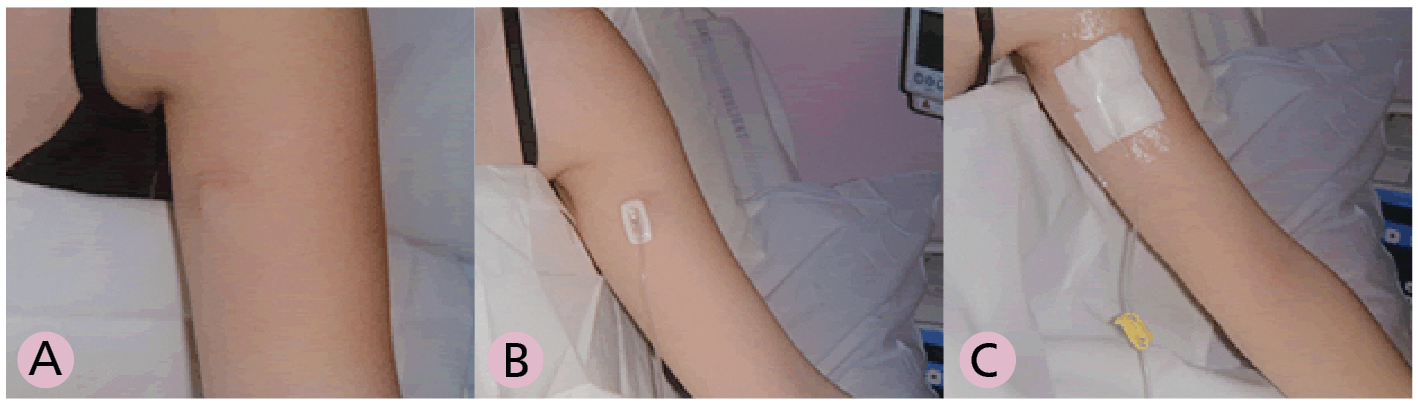 Totally Implantable Venous Access Device - Leeds Teaching Hospitals NHS ...