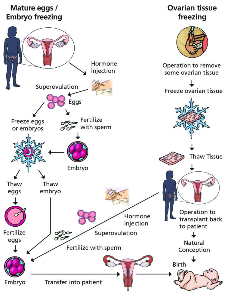 Fertility Preservation Information for girls and young women - Leeds ...