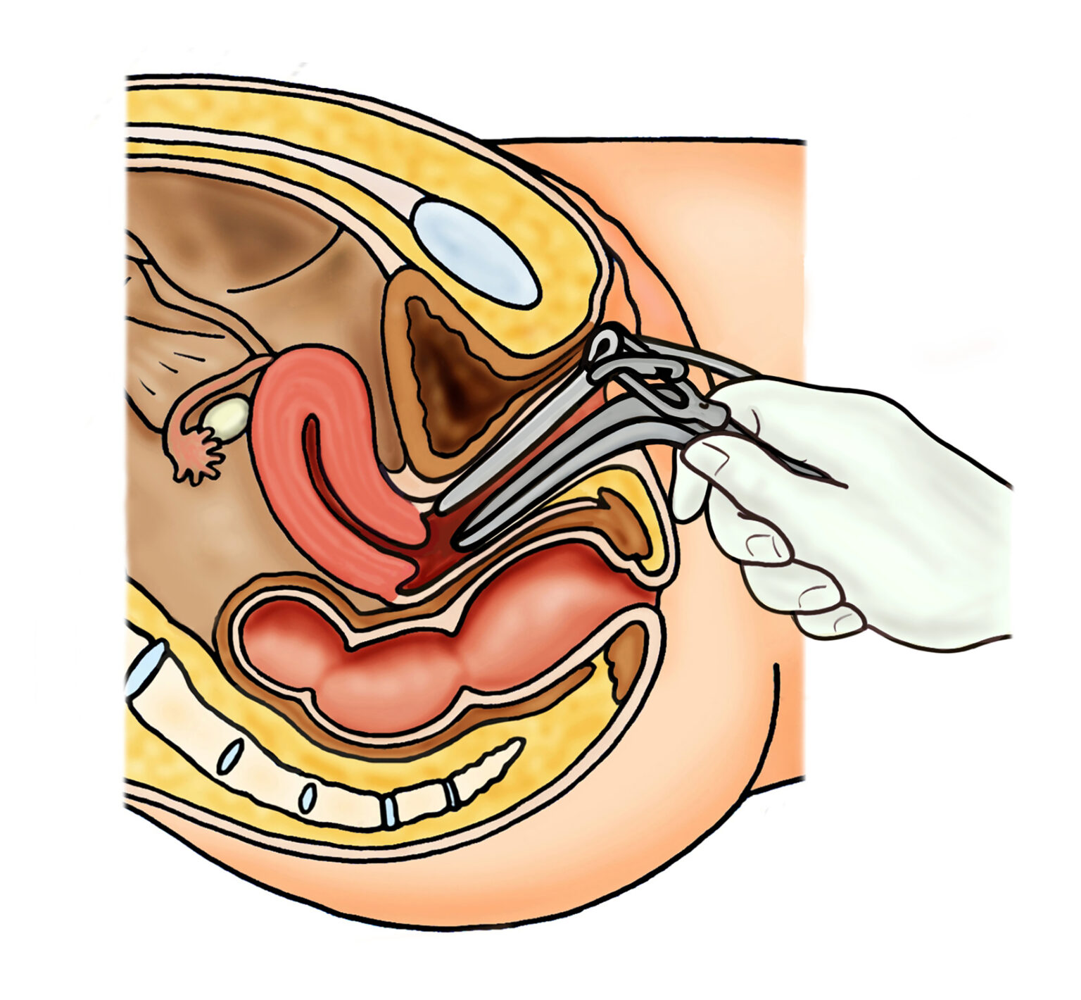 Vaginal Internal Examination Under Anaesthetic Leeds Teaching 7658