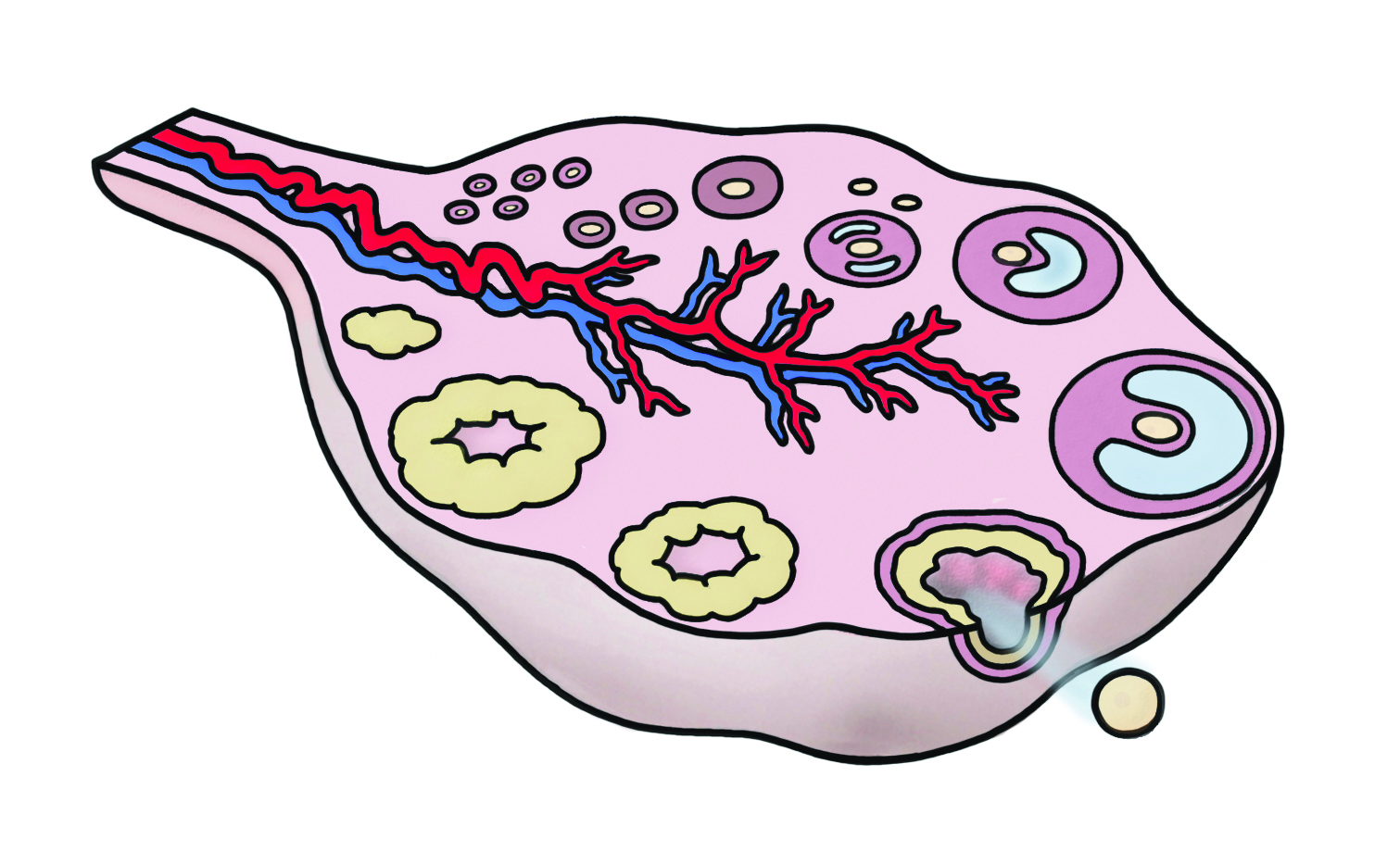 Polycystic Ovary Syndrome - Leeds Teaching Hospitals NHS Trust