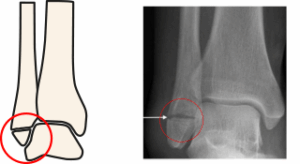 Weber A Fractures of the Ankle - Leeds Teaching Hospitals NHS Trust
