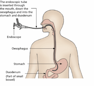 Endoscopy Unit - Having a Gastroscopy - Leeds Teaching Hospitals NHS Trust