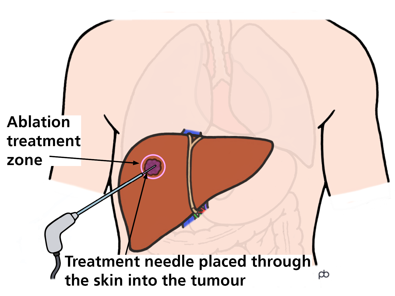 Image guided ablation of liver tumours - Leeds Teaching Hospitals NHS Trust