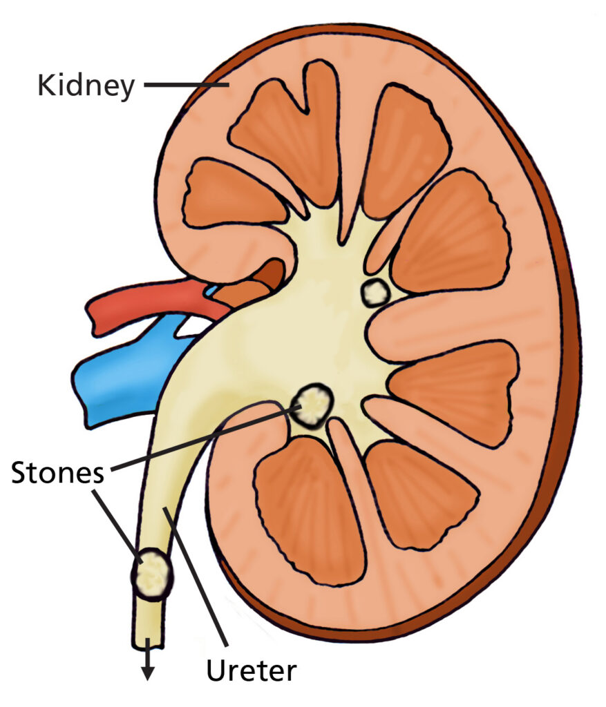 Acute Kidney and Ureteric Stone - CT - Leeds Teaching Hospitals NHS Trust